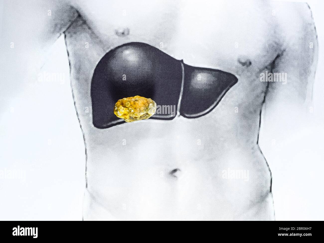 stone in the liver, a schematic image, a large gallstone, the result of ...