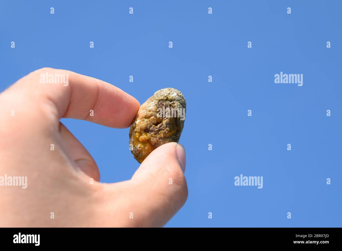 Gallbladder removal hi-res stock photography and images - Alamy