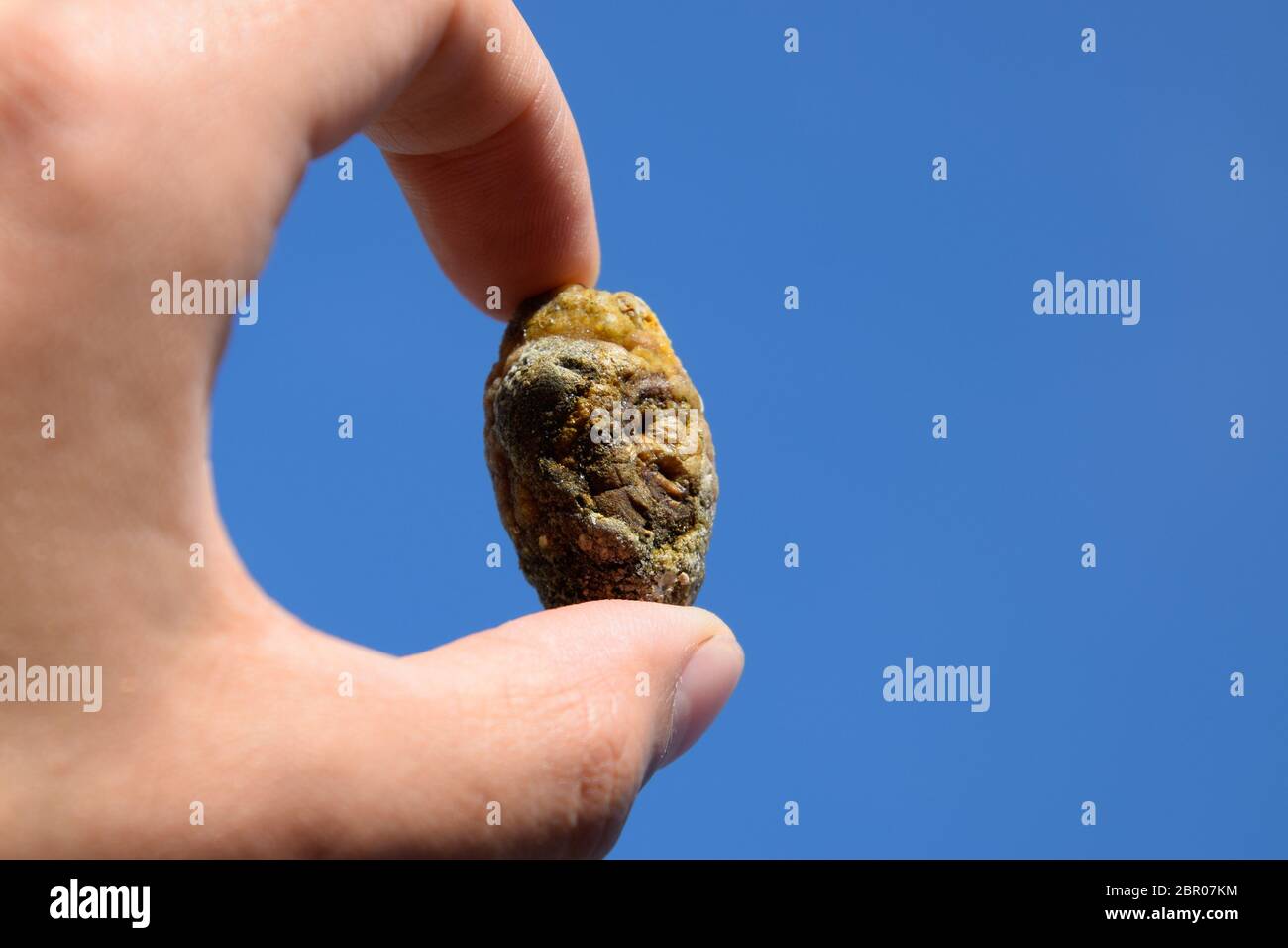 Stone of the gallbladder. The result of gallstones. A calculus of ...