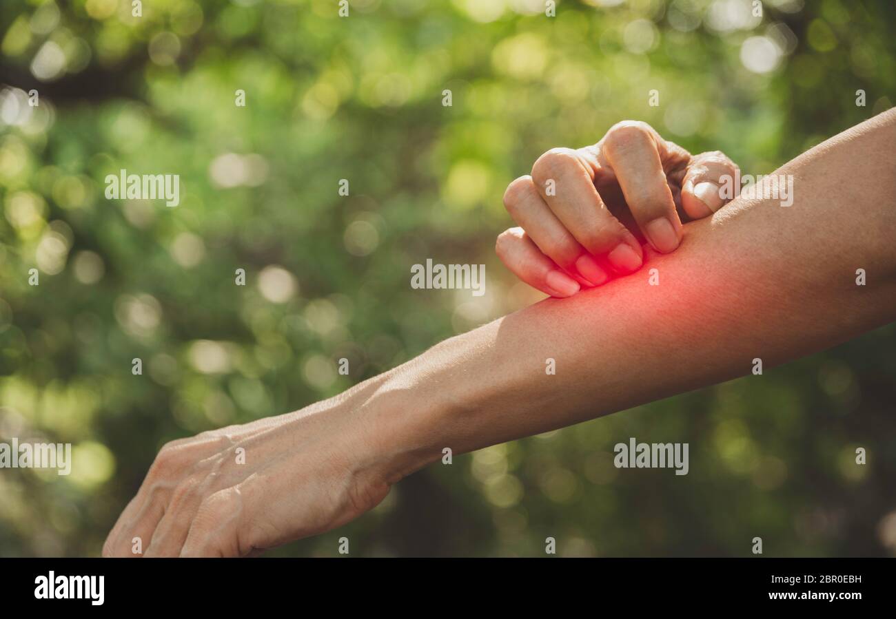 Man scratch itch with hand. Man scratching his hand healthcare concept ...
