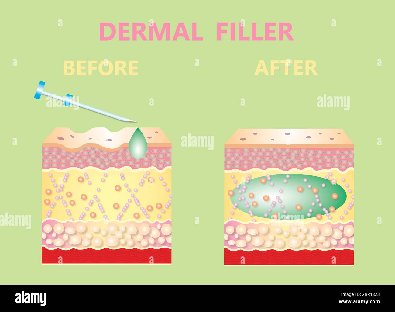 Cosmetic or dermal fillers. Young female with clean fresh skin ...