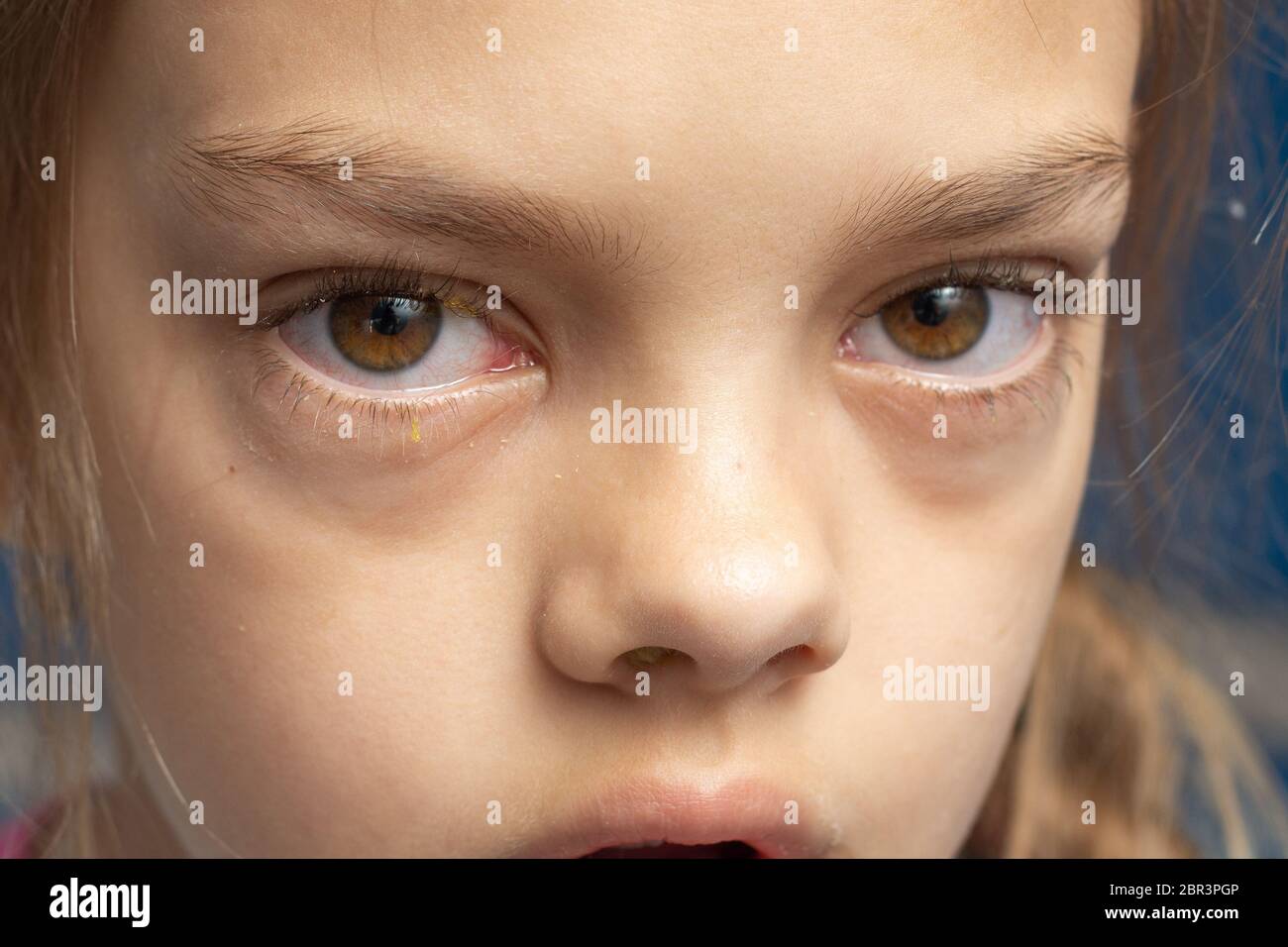 Irritated eyes of a girl who got sick with conjunctivitis Stock Photo ...