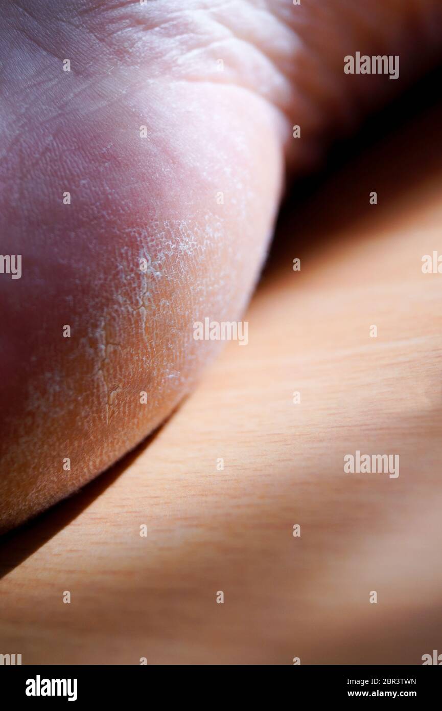 Closeup image of a heel on the foot with a white callus. Image for ...