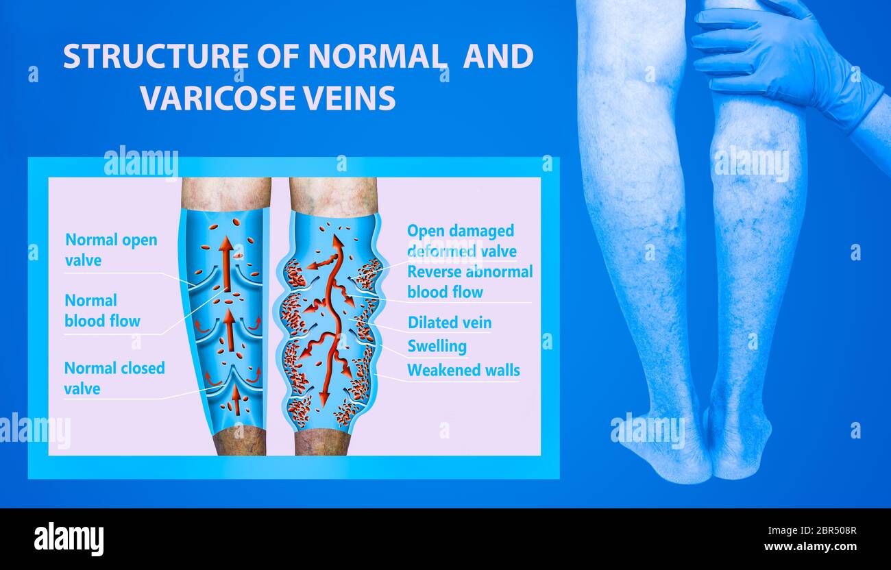Varicose veins on a female senior legs. The structure of normal and ...