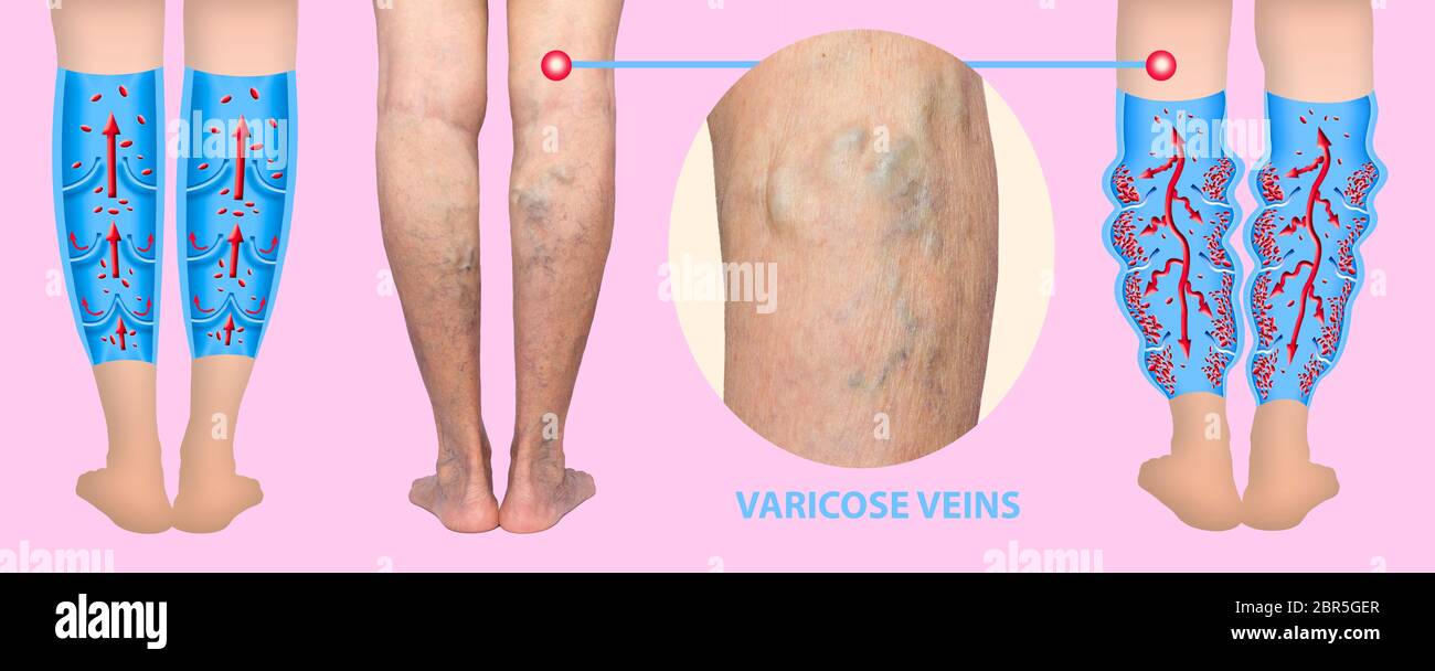 Varicose veins on a female senior legs. The structure of normal and ...