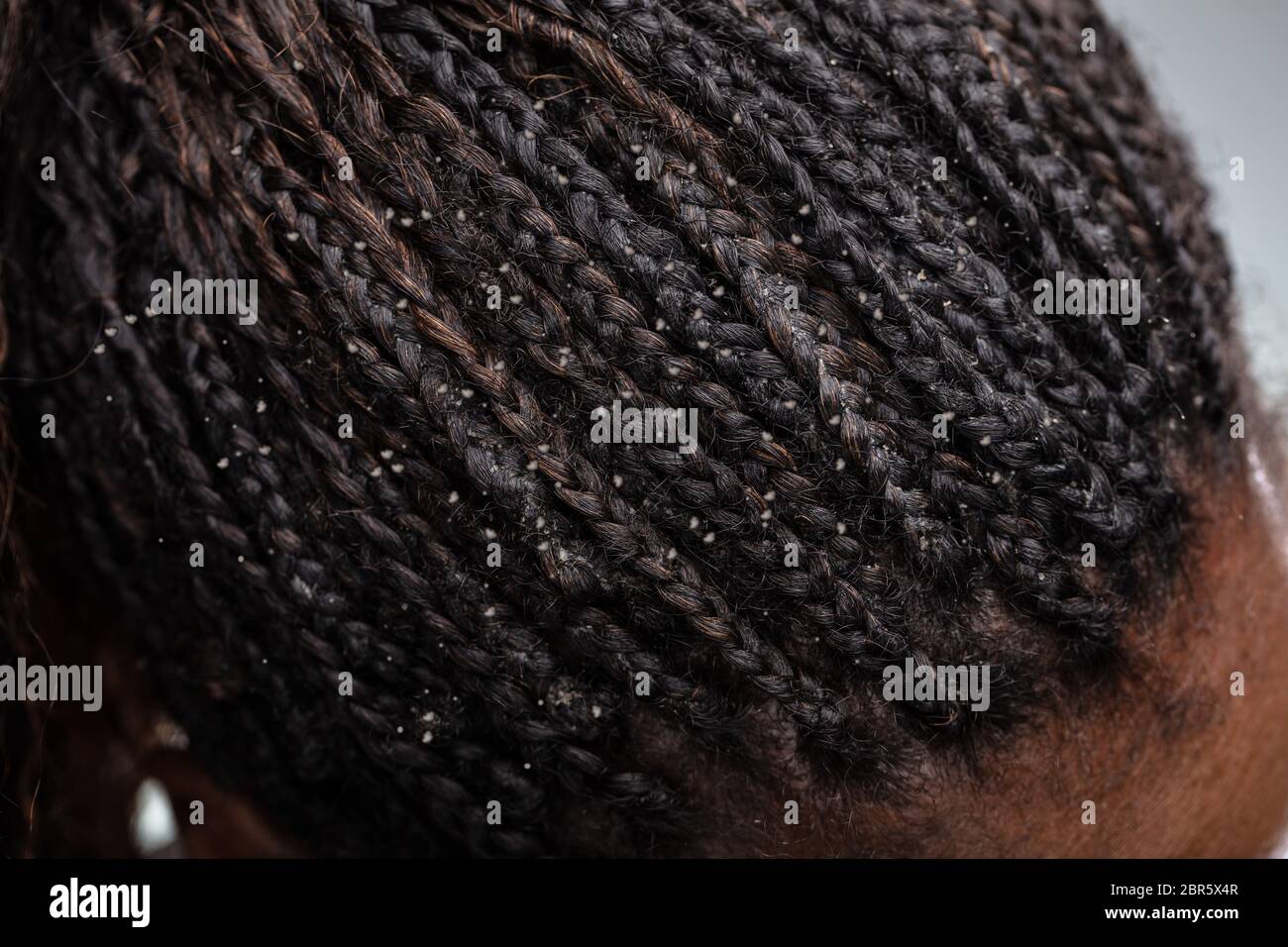 Close-up Photo Of Dandruff In Woman's Hair Stock Photo - Alamy