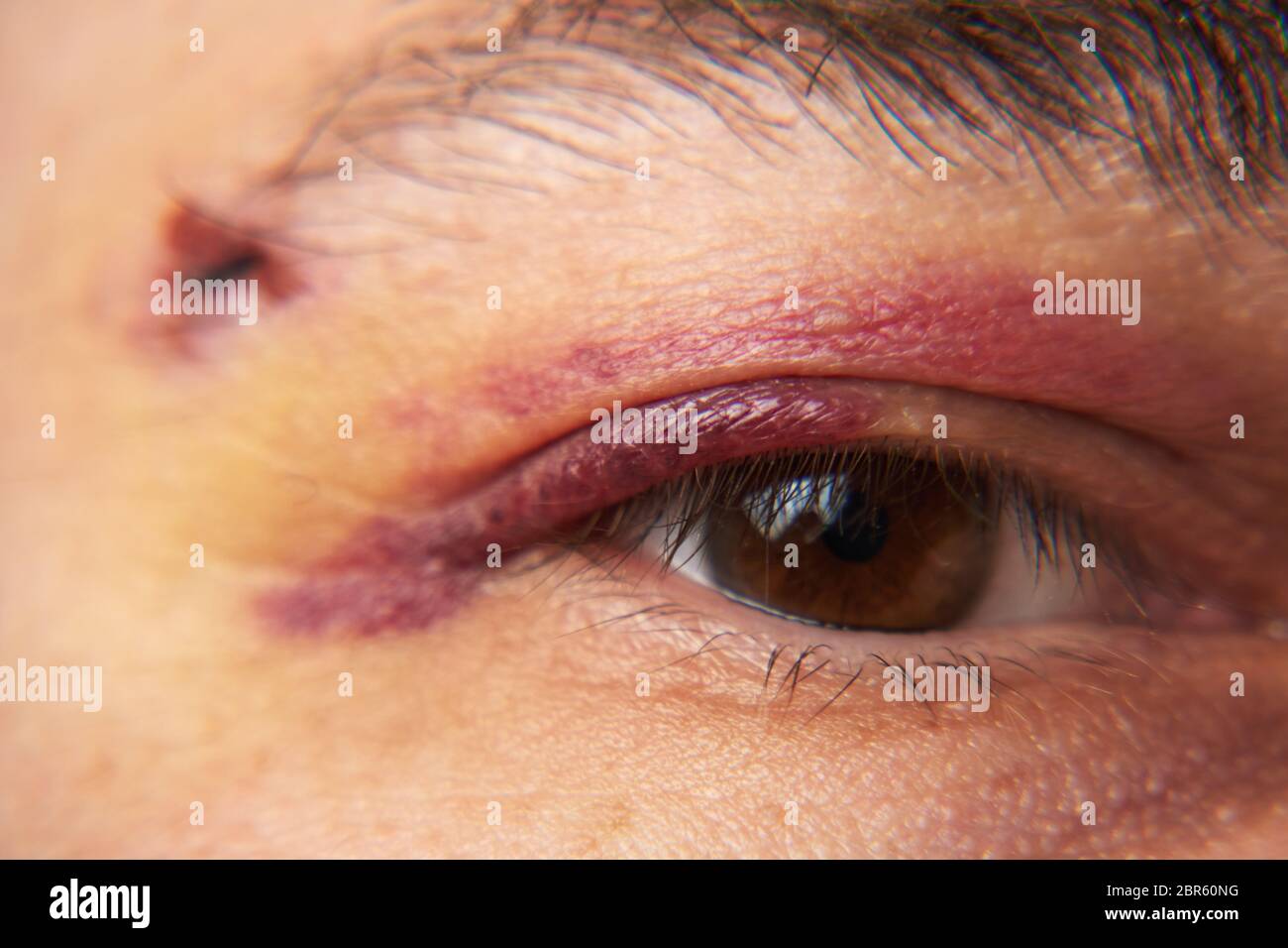 close view of a bruise near the eye, the face of a man with a hematoma ...