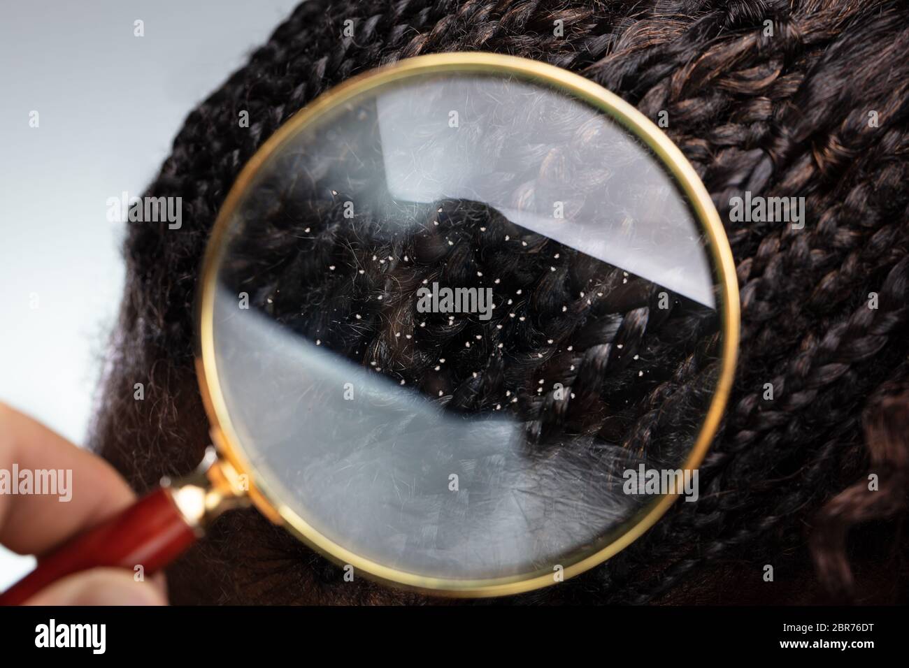 Close-up Of A Dandruff In Black Hair Seen Through Magnifying Glass ...