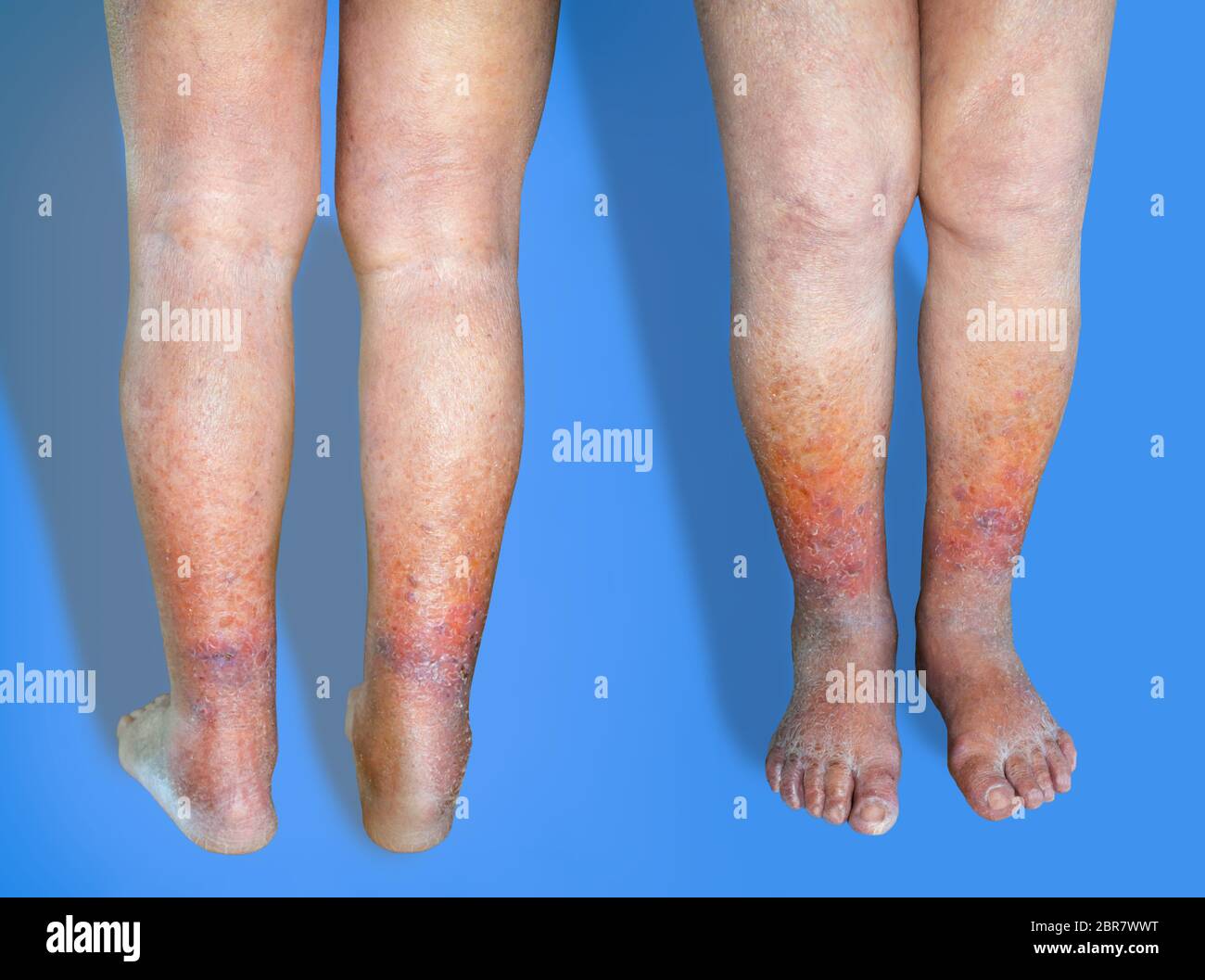 What Is A Dvt In The Leg