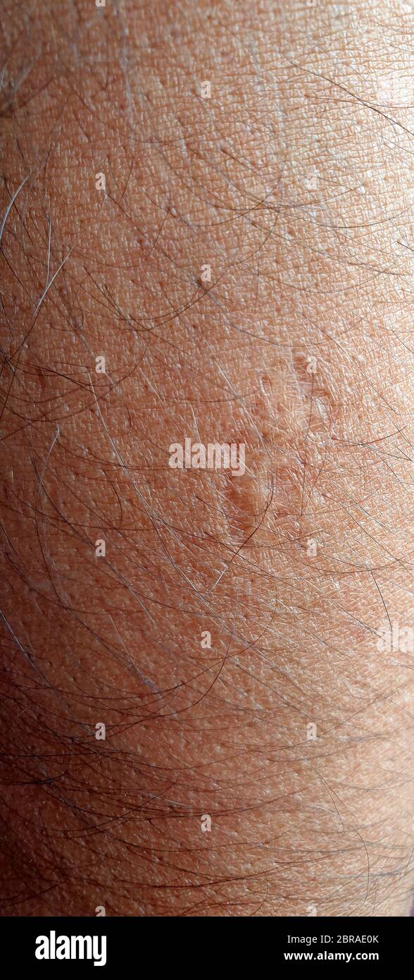 A bite on arm by a child is shown in this picture. Used for health care ...