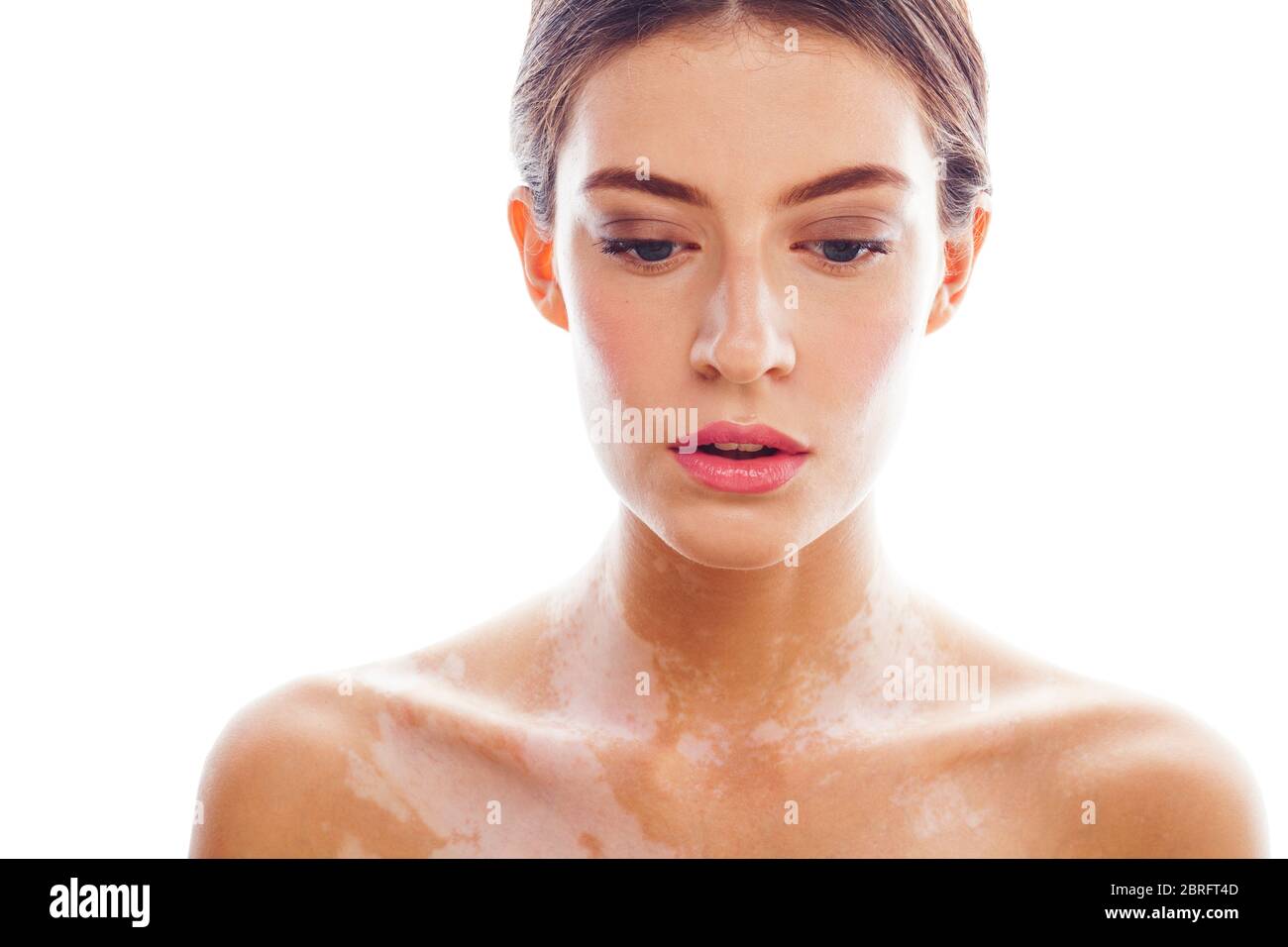 beautiful young brunette woman with vitiligo disease isolated on white ...