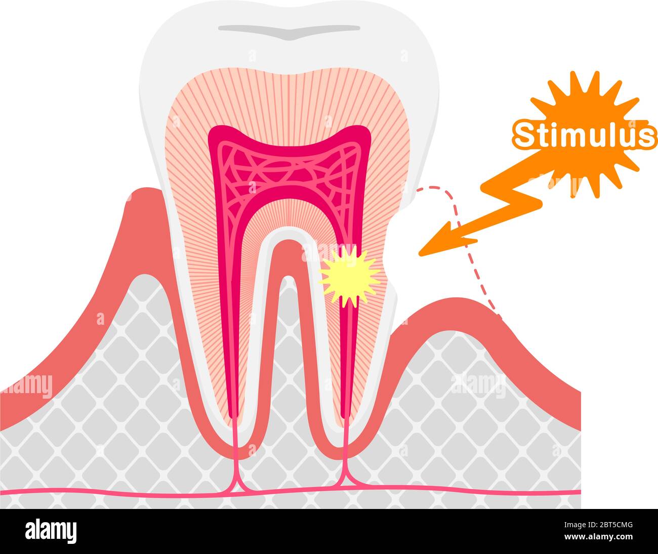 Cause and mechanism of Sensitive teeth vector illustration Stock Vector ...