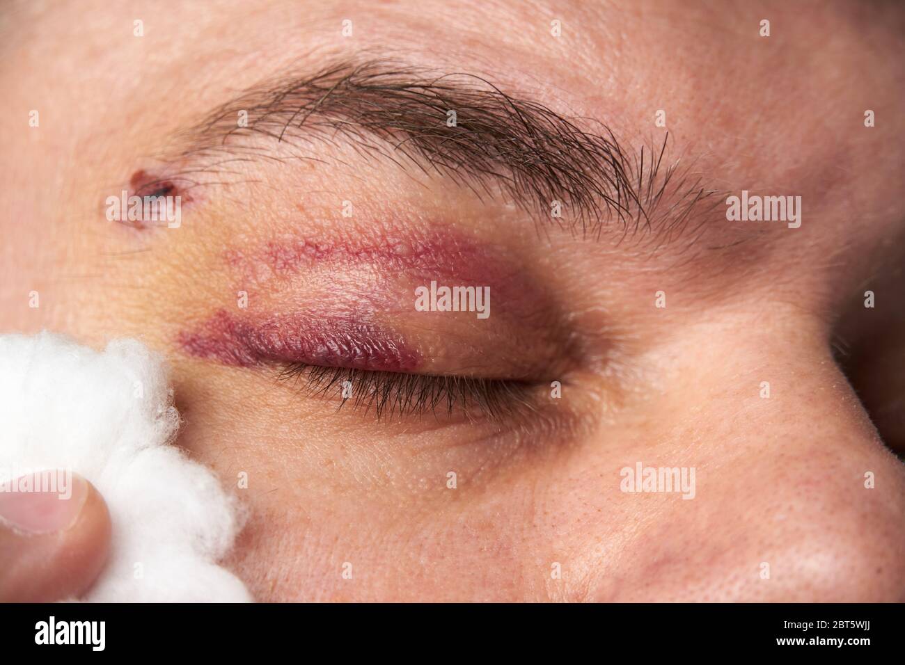 close view of a bruise near the eye, the face of a man with a hematoma ...