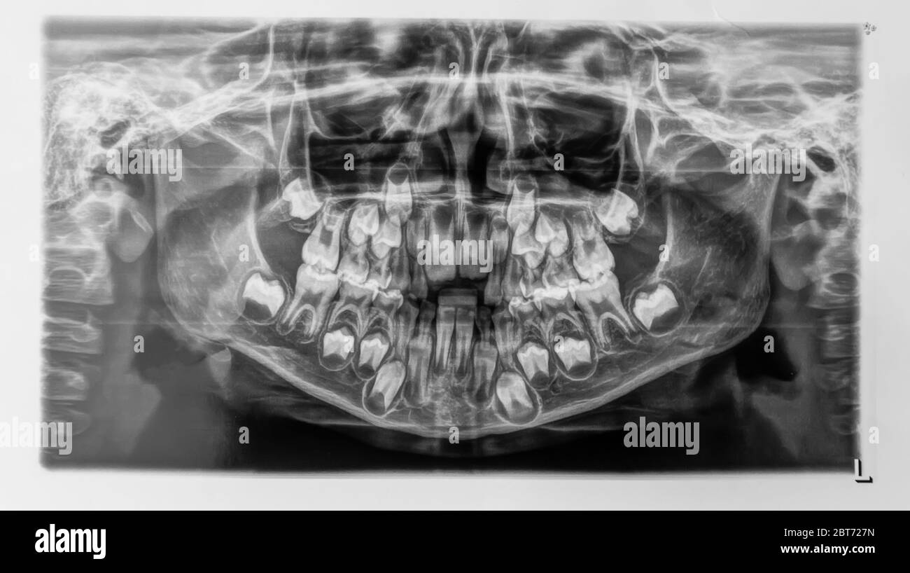 Panoramic shot of children's teeth. Selective focus. child Stock Photo ...