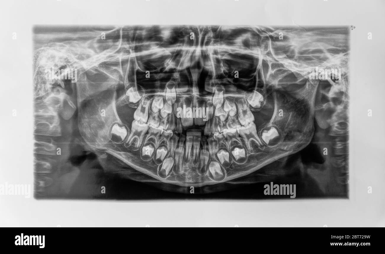 Child teeth xray hi-res stock photography and images - Alamy