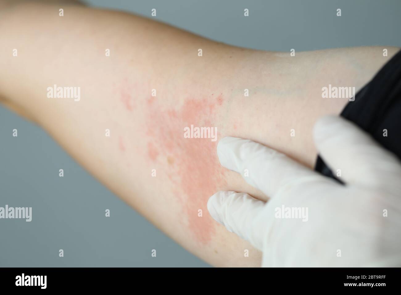 Close-up red rash on white skin hand, examination Stock Photo - Alamy