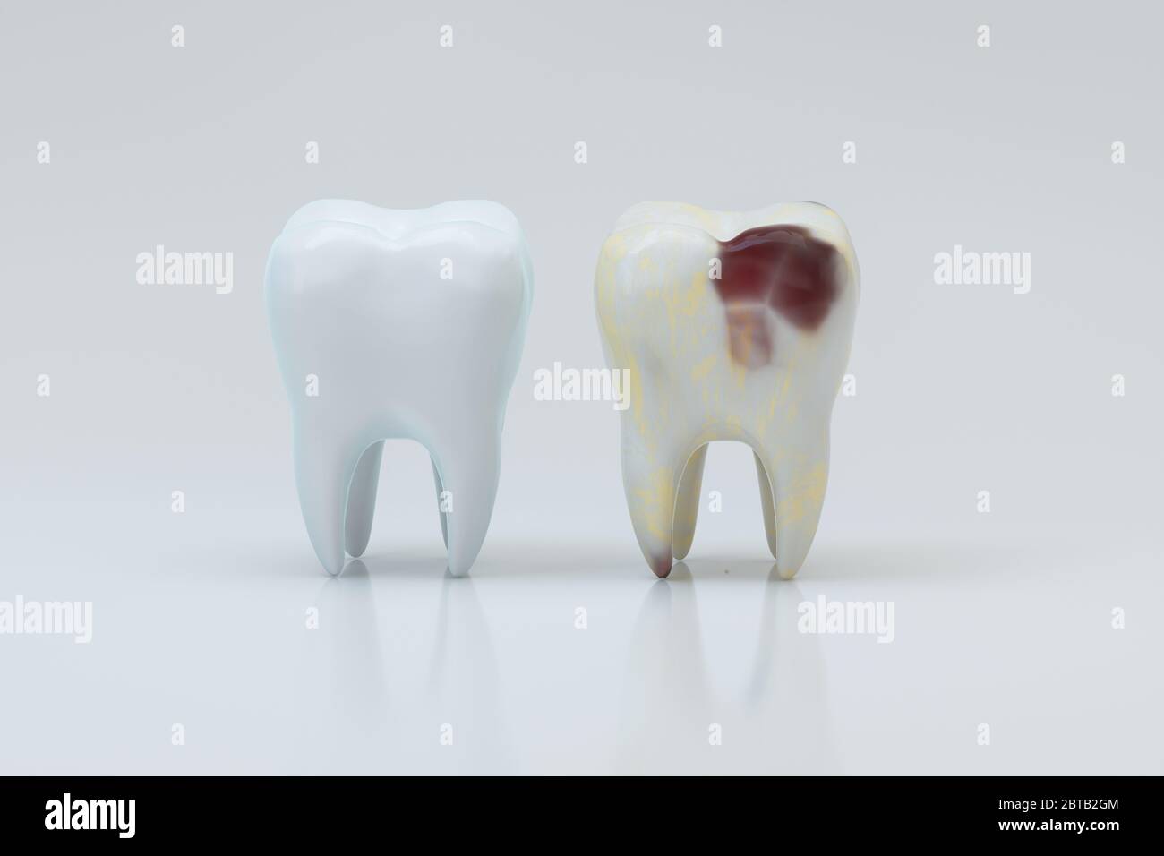 Decayed molar hi-res stock photography and images - Alamy