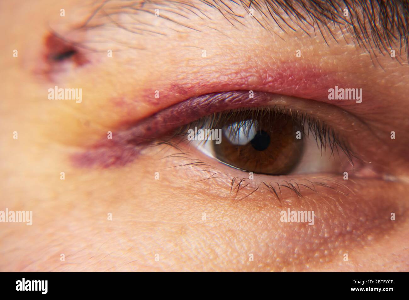close view of a bruise near the eye, the face of a man with a hematoma ...