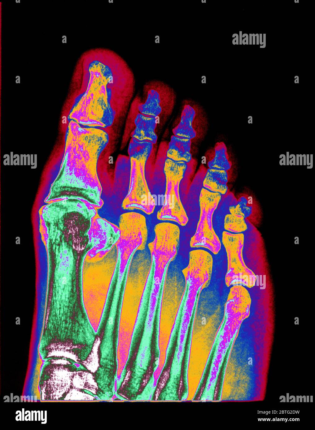 Coloured x-ray, foot Stock Photo - Alamy