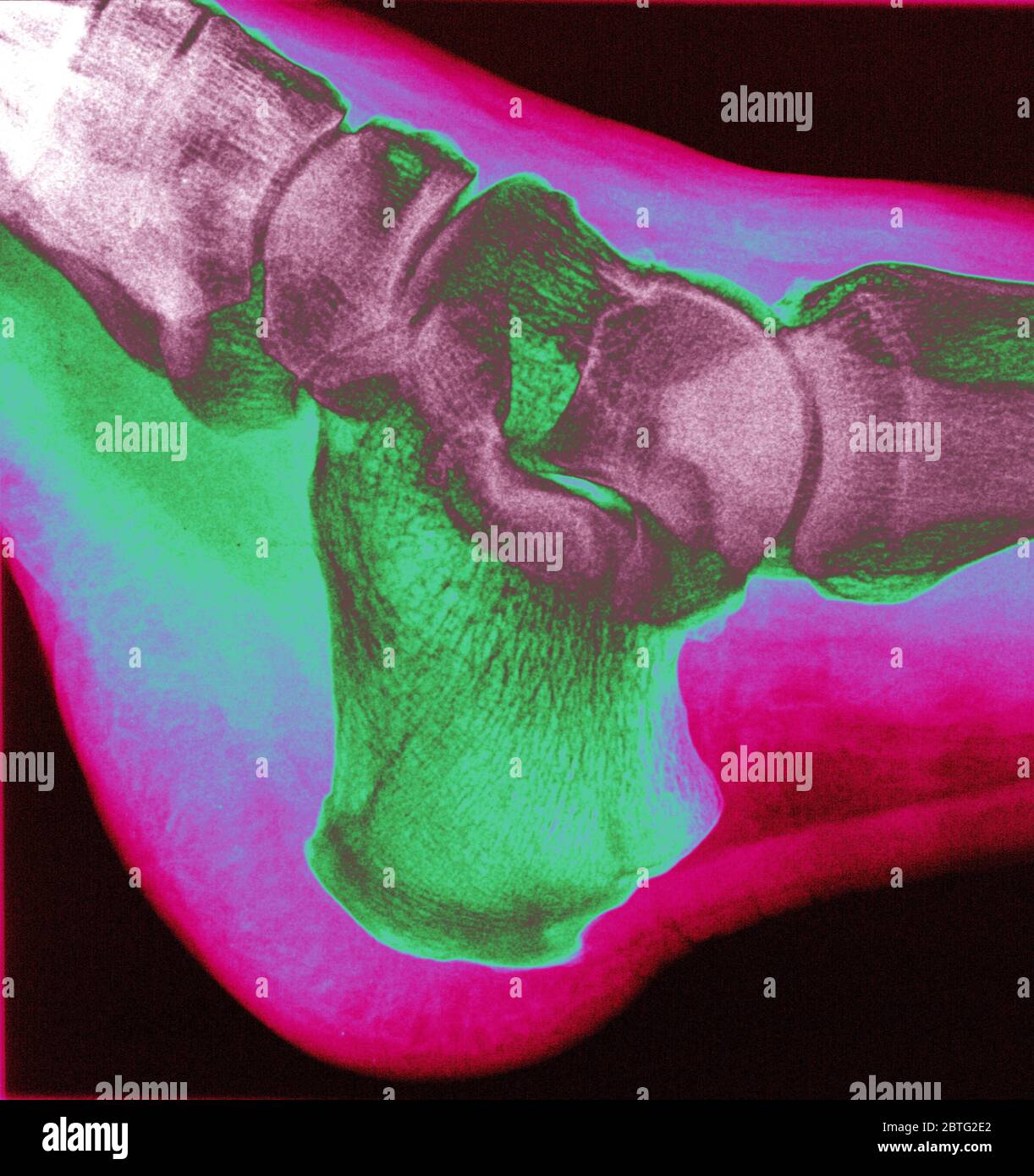 Coloured x ray hi-res stock photography and images - Alamy
