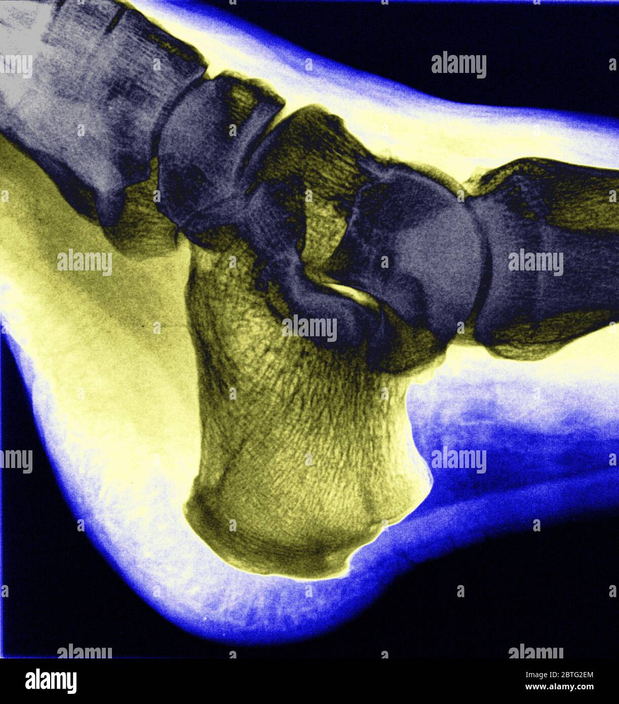 Coloured x-ray, ankle Stock Photo - Alamy