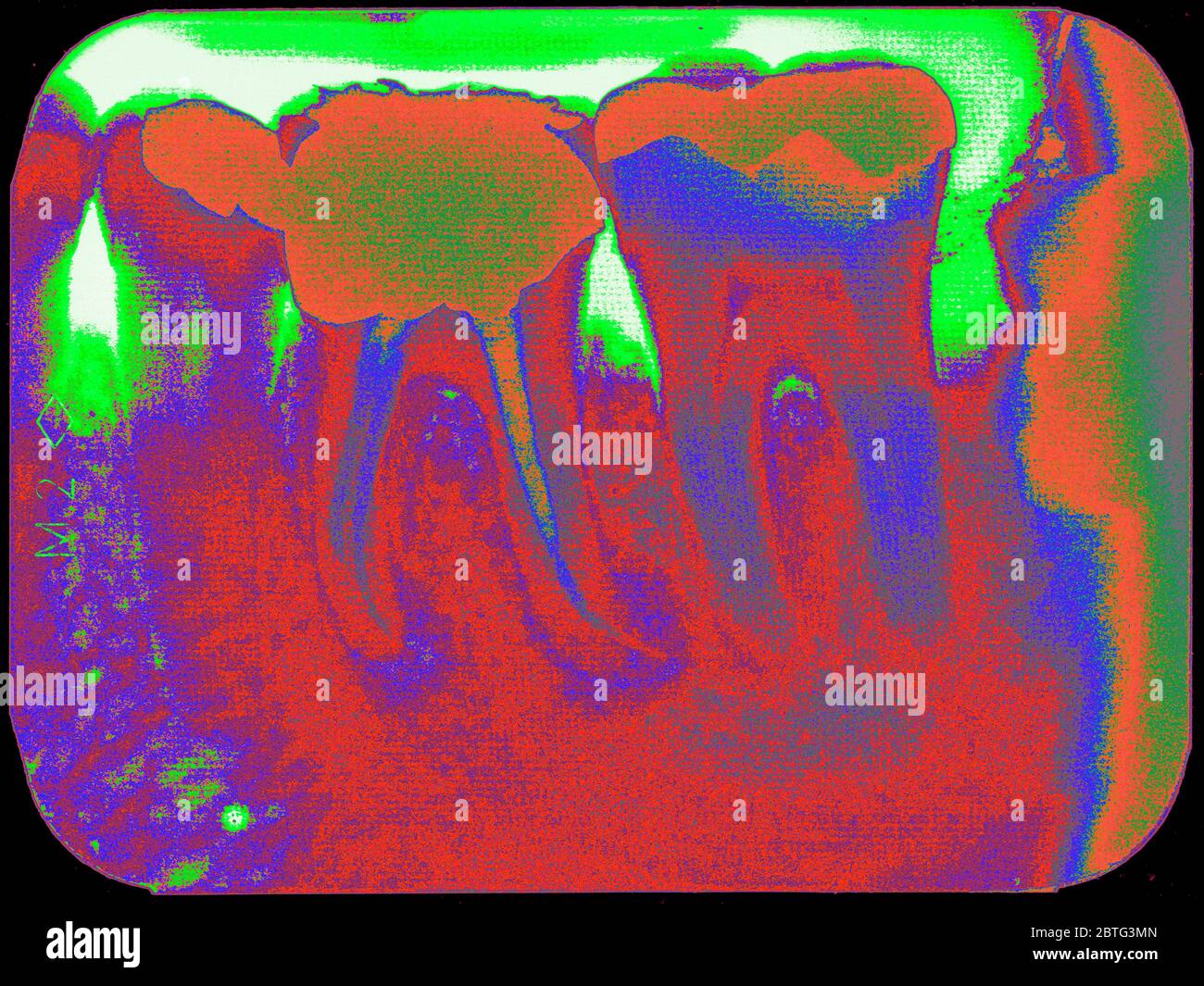 Root canal treatment hi-res stock photography and images - Alamy