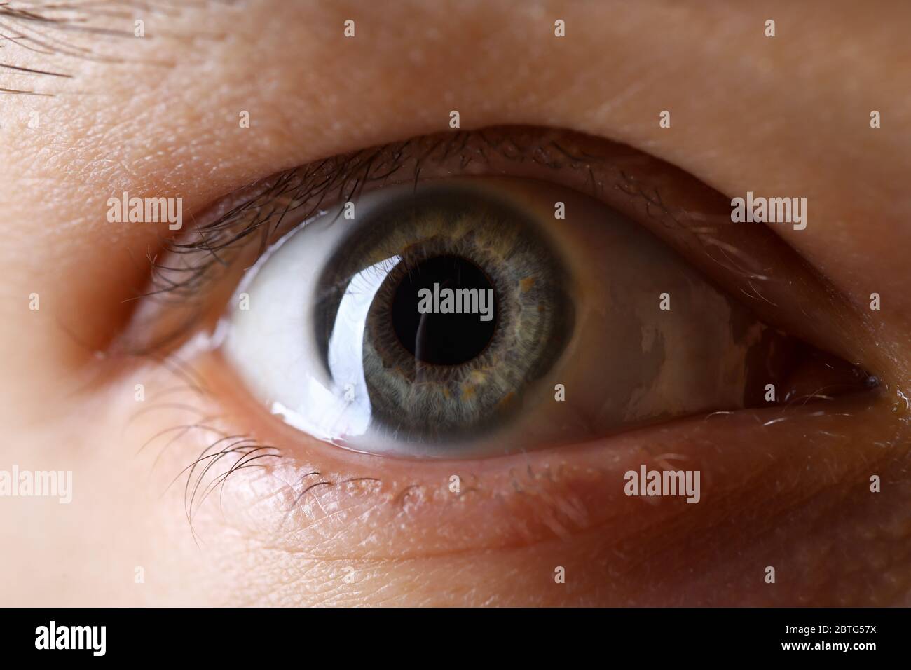 Cataract of right eye hi-res stock photography and images - Alamy