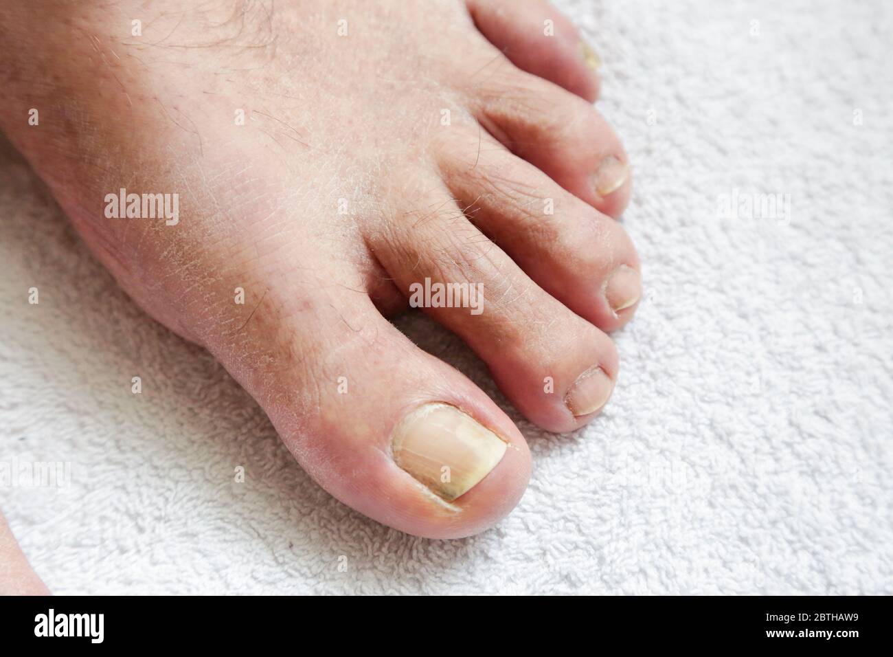 Details of man nails with fungal infection known as onychomycosis ...