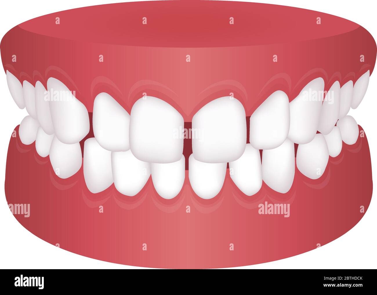 Teeth trouble ( bite type ) vector illustration / /Excessive Spacing ...
