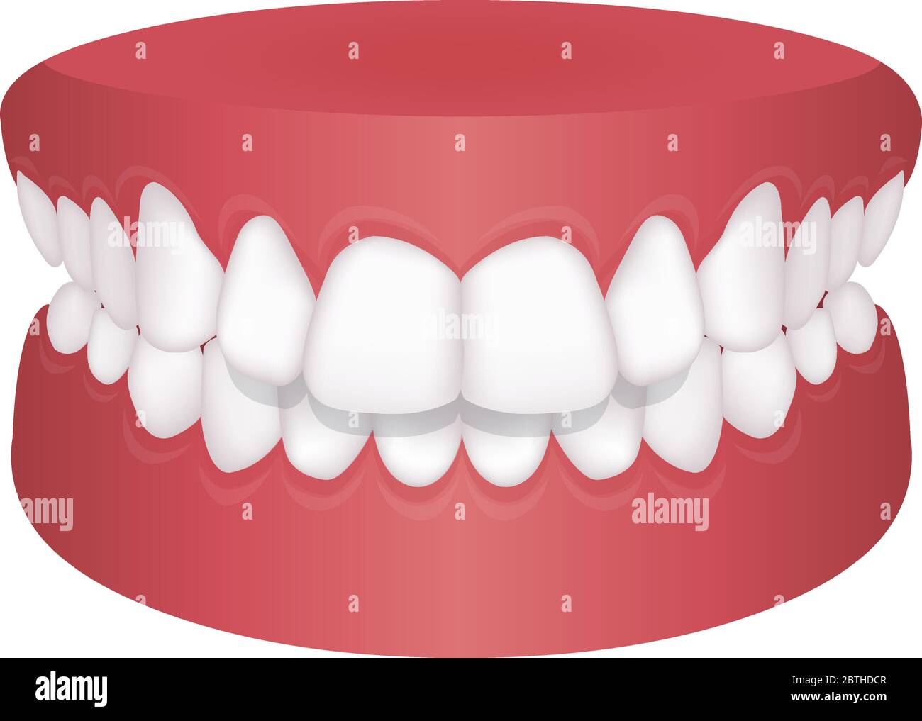 Teeth trouble ( bite type ) vector illustration /Overbite (Back teeth ...