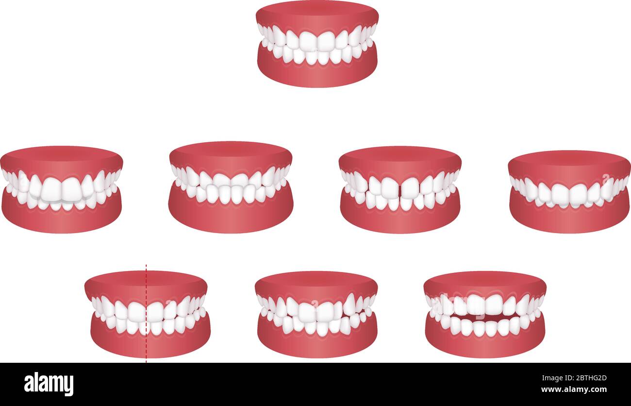 Teeth trouble ( bite type ) vector illustration set Stock Vector Image ...