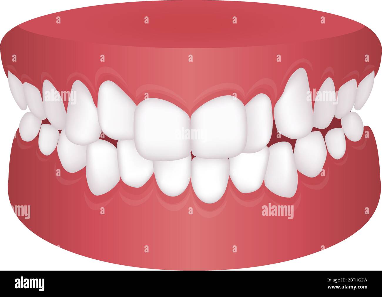 Teeth trouble ( bite type ) vector illustration /Crowding Stock Vector ...