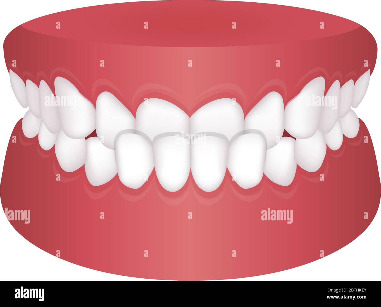 Teeth trouble ( bite type ) vector illustration /Underbite Stock Vector ...