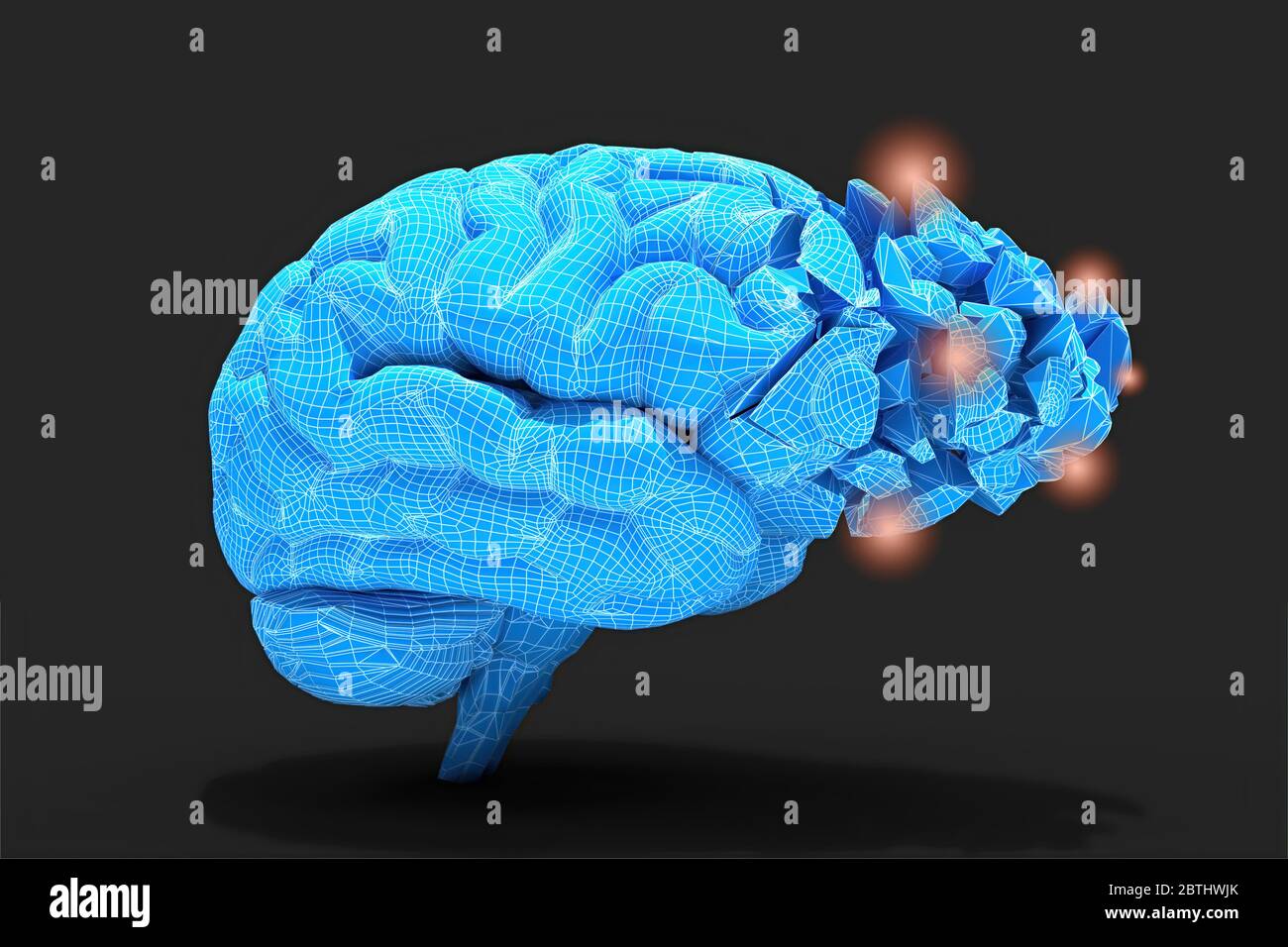 Inflammation of brain hi-res stock photography and images - Alamy