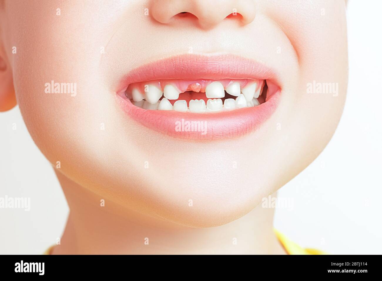Without tooth hi-res stock photography and images - Alamy
