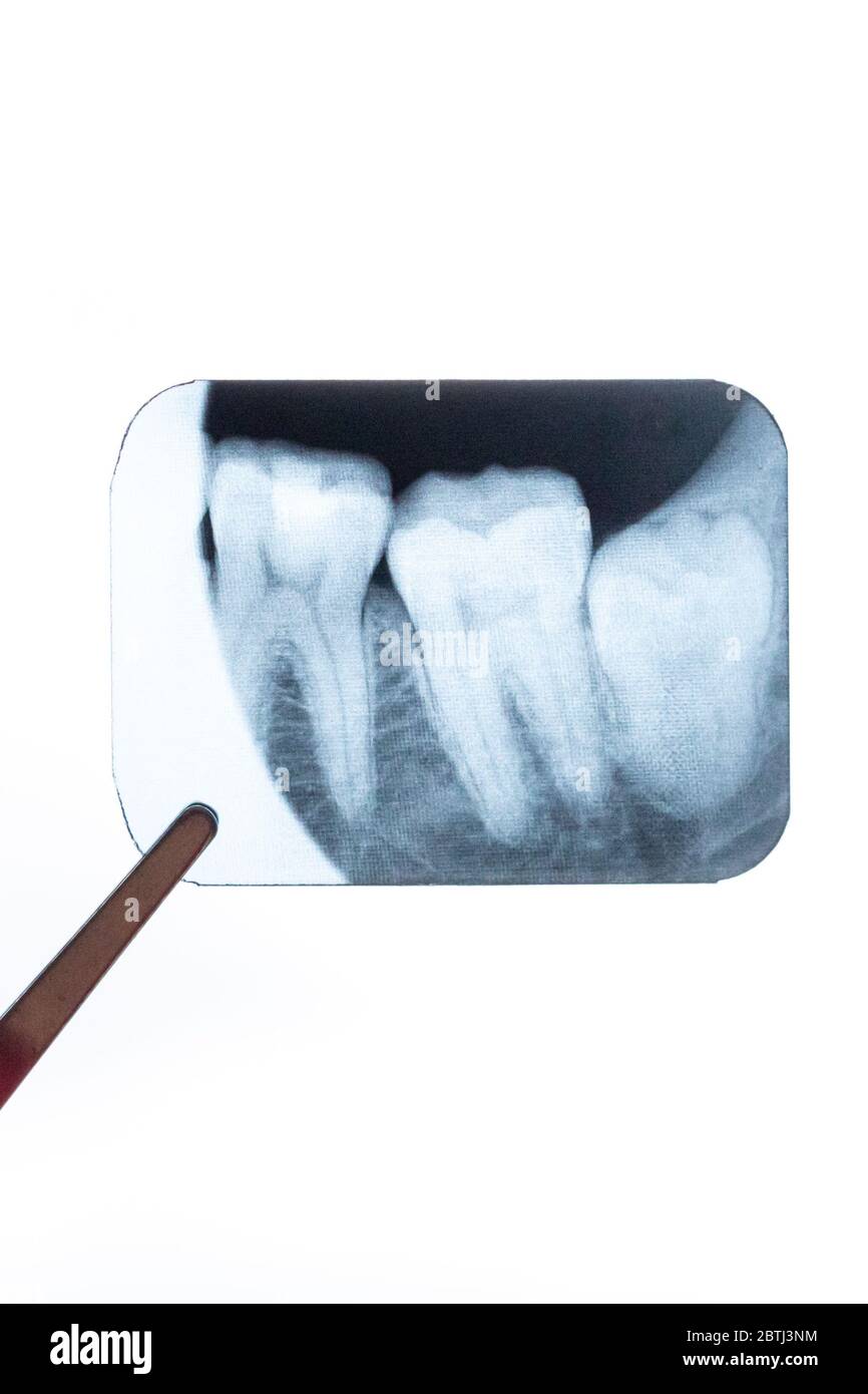 X-ray of wisdom teeth in the dentist's hands Stock Photo - Alamy