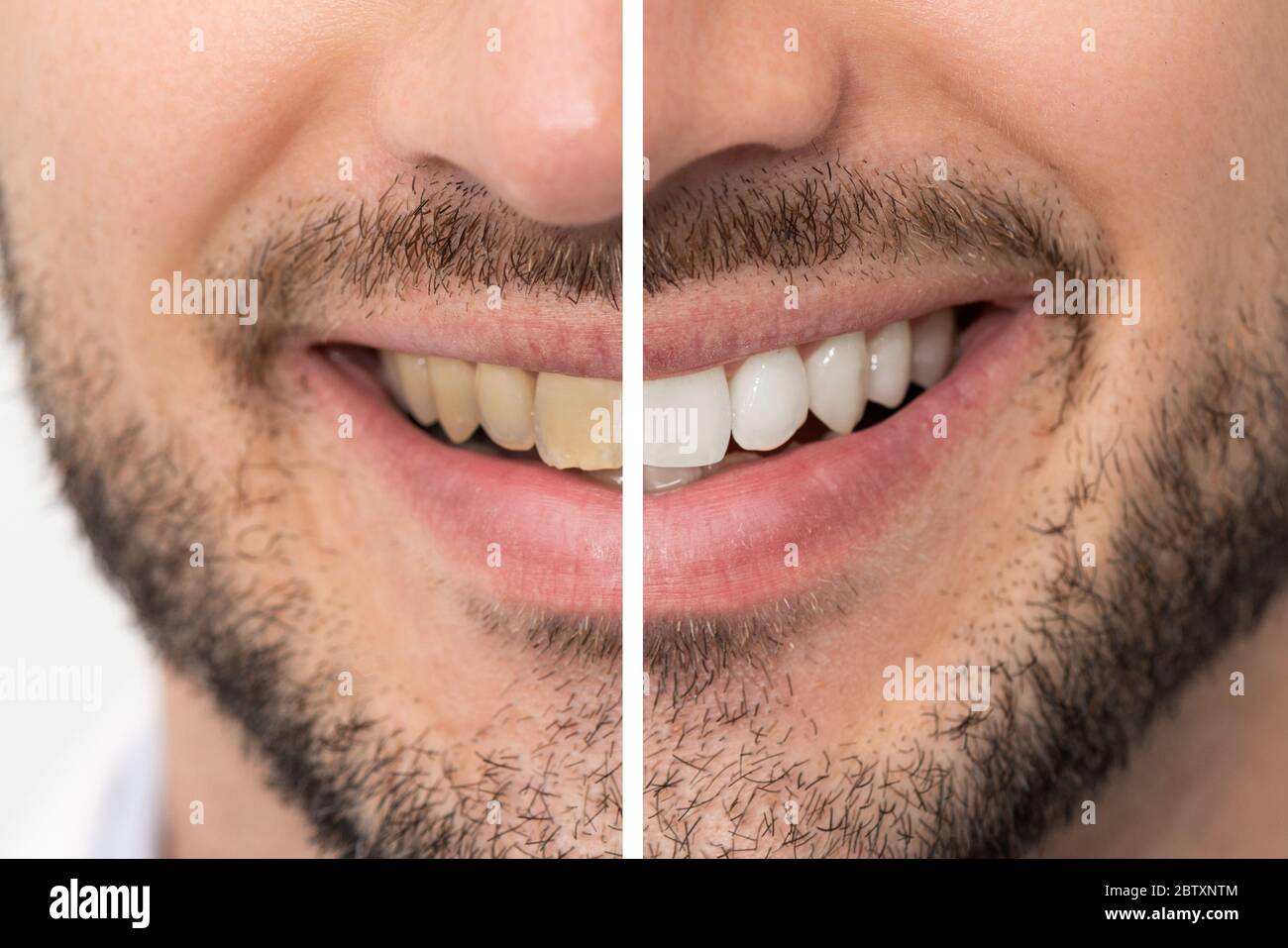 Teeth before and after whitening. Dental care concept Stock Photo - Alamy