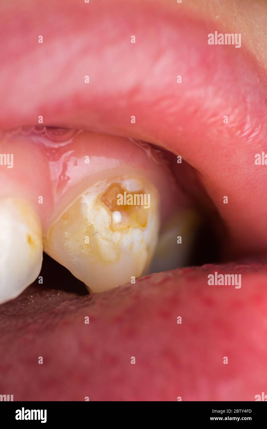 Kid patient open mouth showing cavities teeth decay. Close up of ...