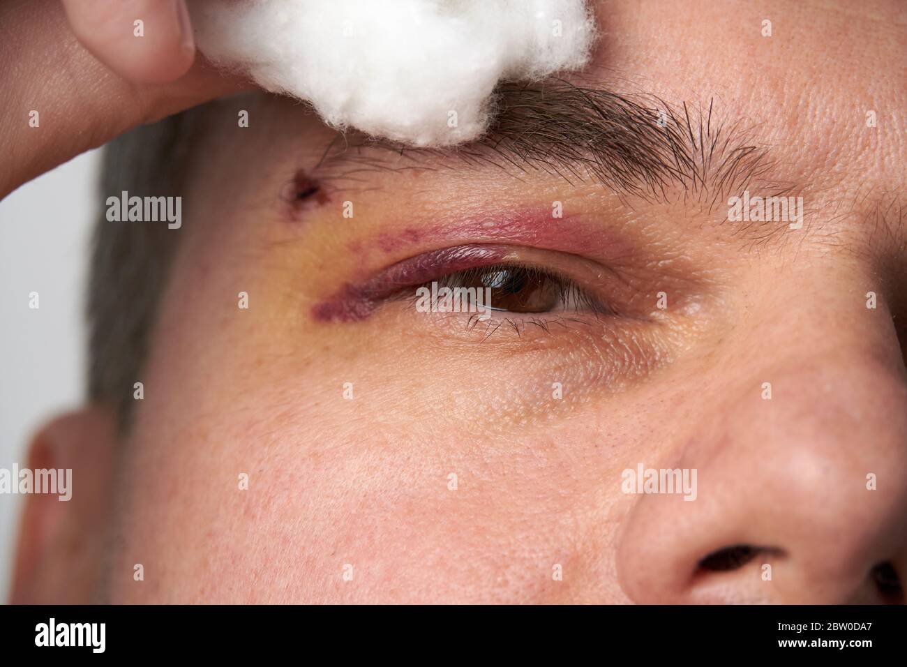 Portrait man swollen face hi-res stock photography and images - Alamy