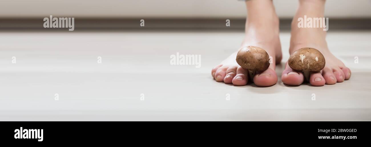 Smelly Fungus. Toenail Mushroom. Fungi Toenail Onychomycosis Stock ...