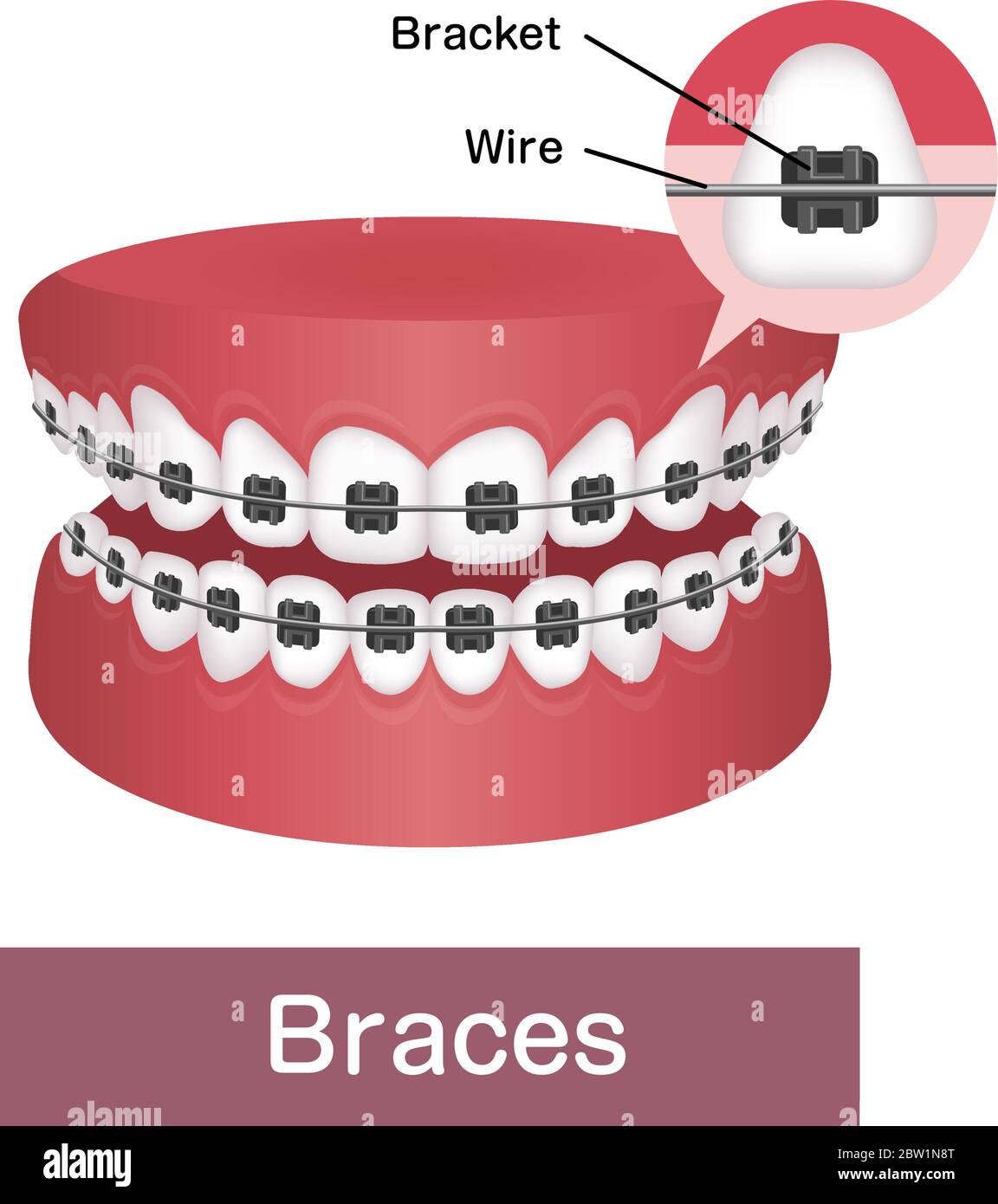 Dental Braces Flat Vector Illustration Stock Vector Image And Art Alamy
