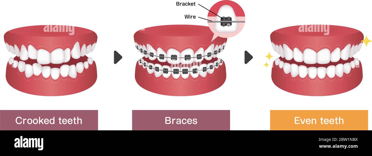 Dental braces process vector illustration Stock Vector Image & Art - Alamy