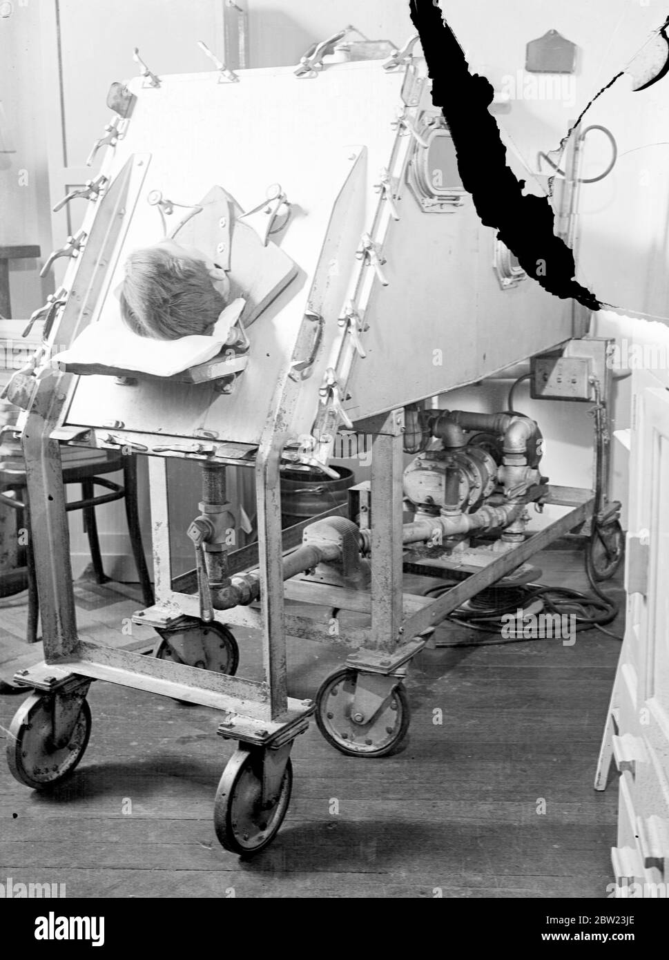 'Iron lung' saves boy's life at Guys. Marvellous machine that breathes ...