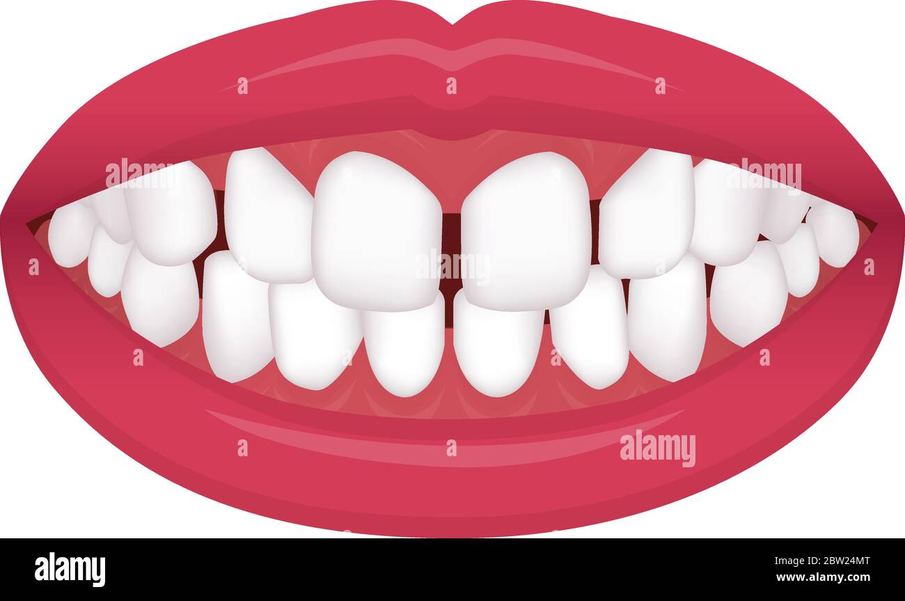 Teeth trouble ( bite type / crooked teeth ) vector illustration ...
