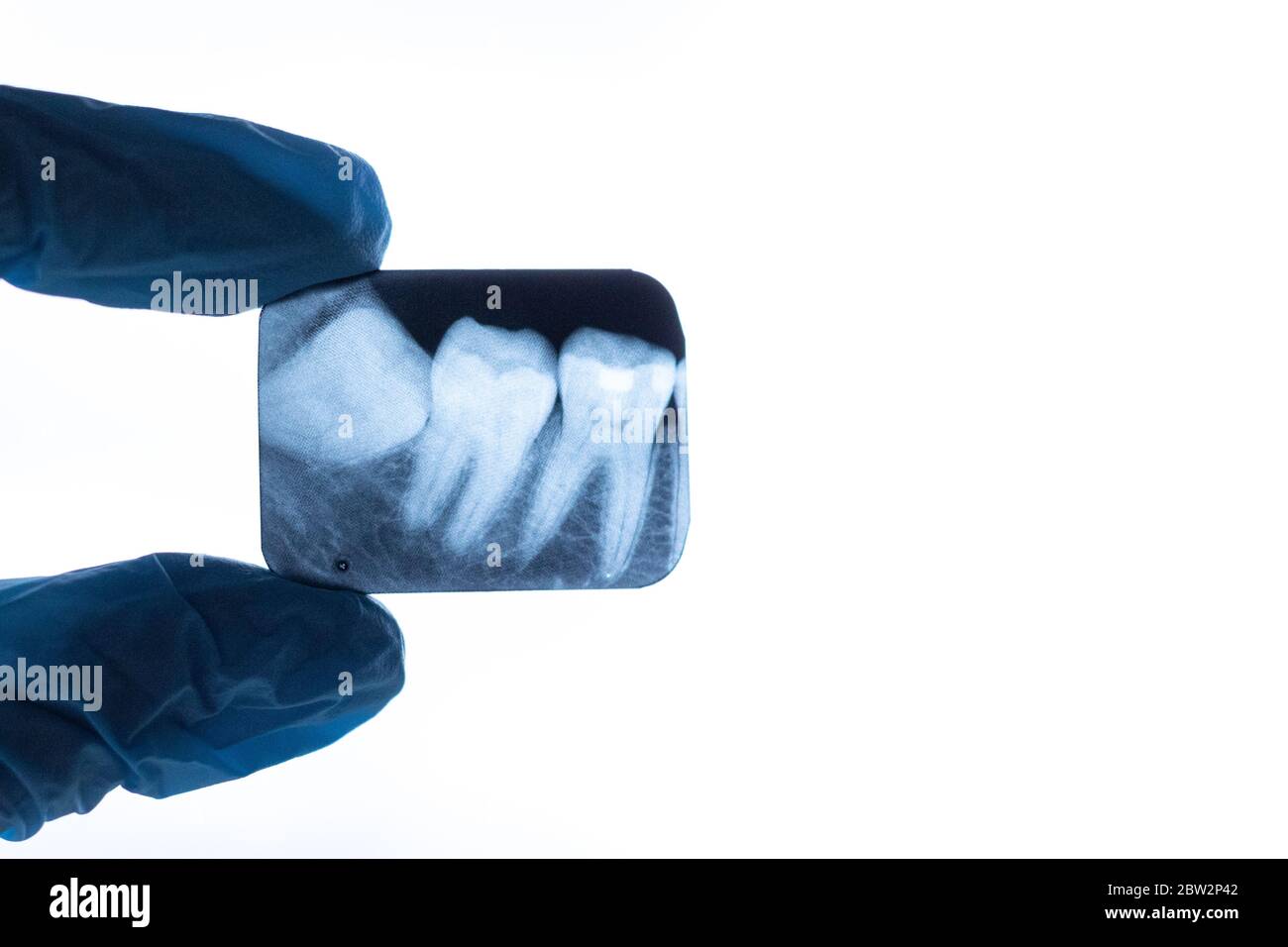 Wisdom teeth x ray hi-res stock photography and images - Alamy