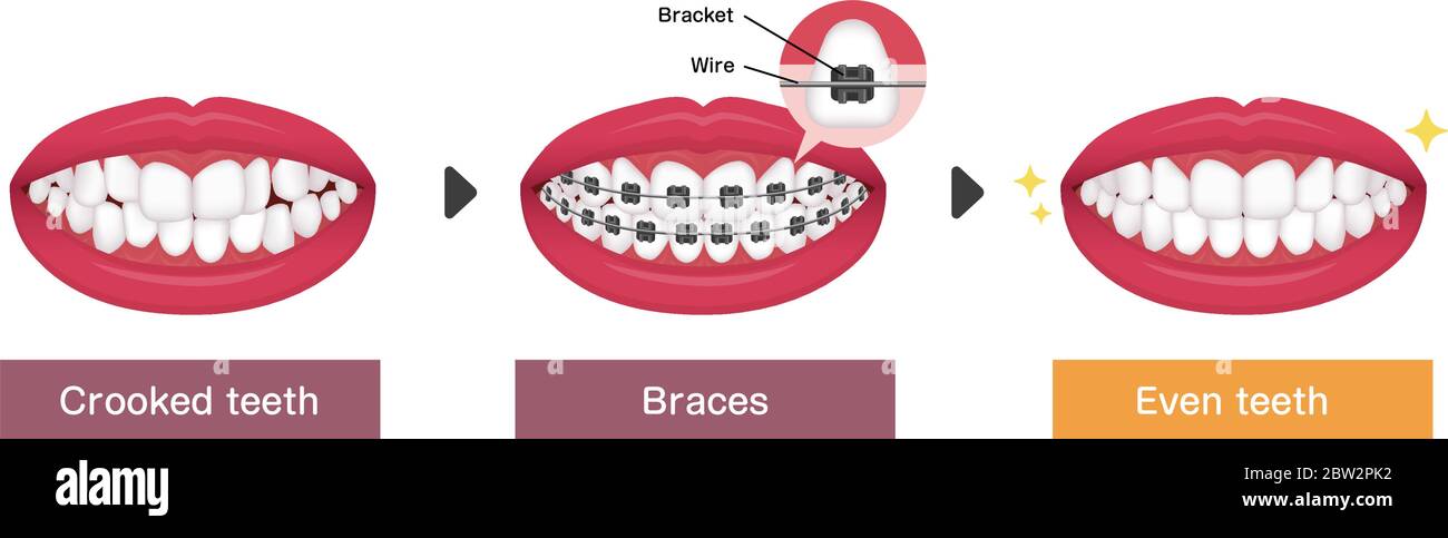 Dental braces process vector illustration Stock Vector Image & Art - Alamy