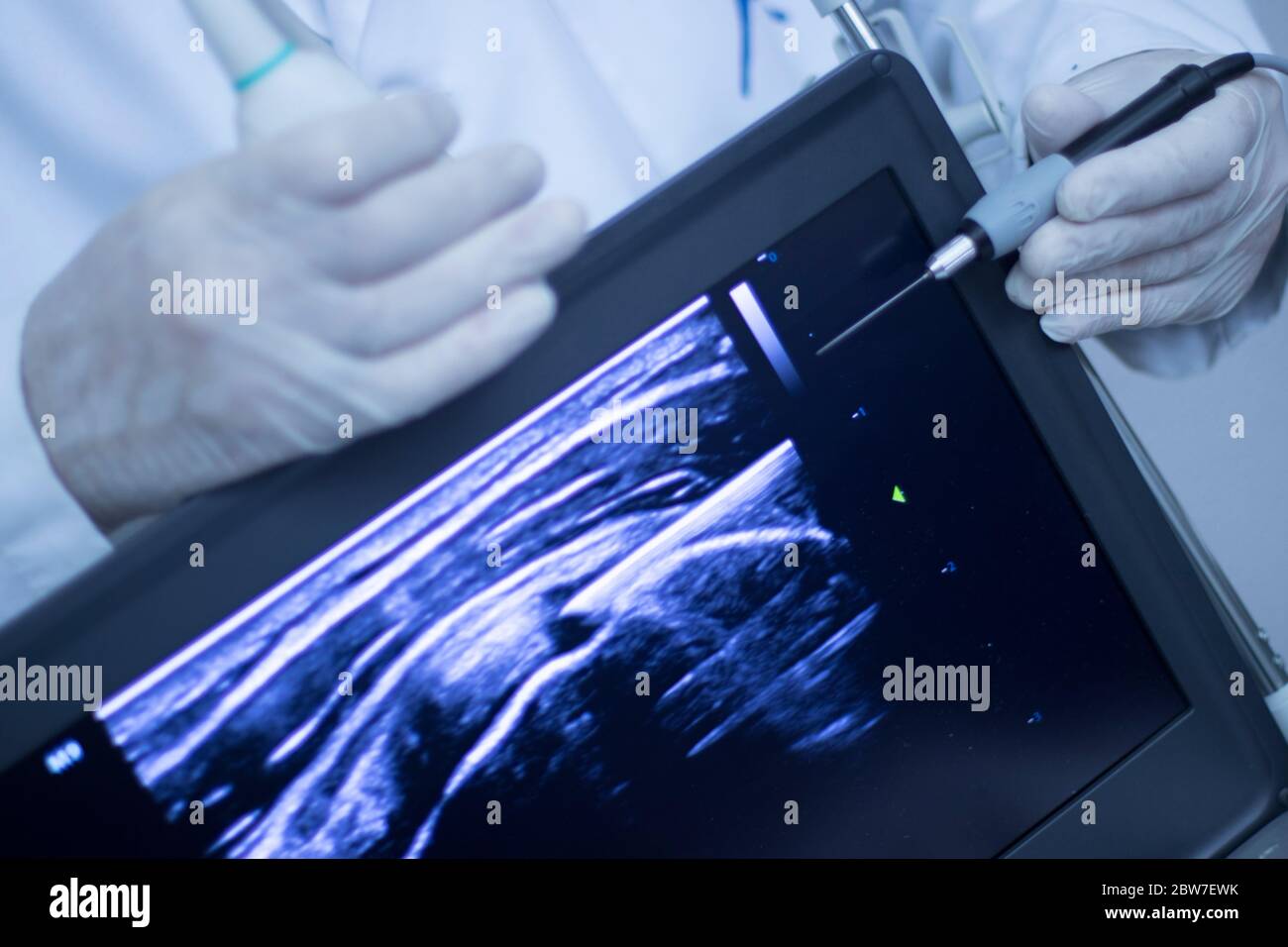 EPI Intratissue Percutaneous Electrolysis dry needling ultrasound ...