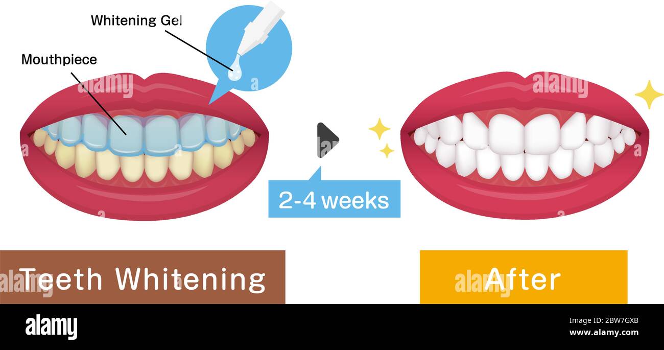 Teeth whitening vector illustration / before and after Stock Vector ...