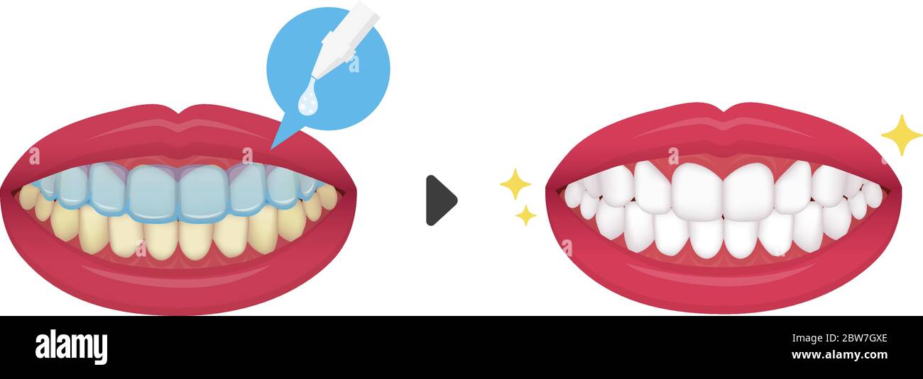 Teeth whitening vector illustration / before and after (No text Stock ...