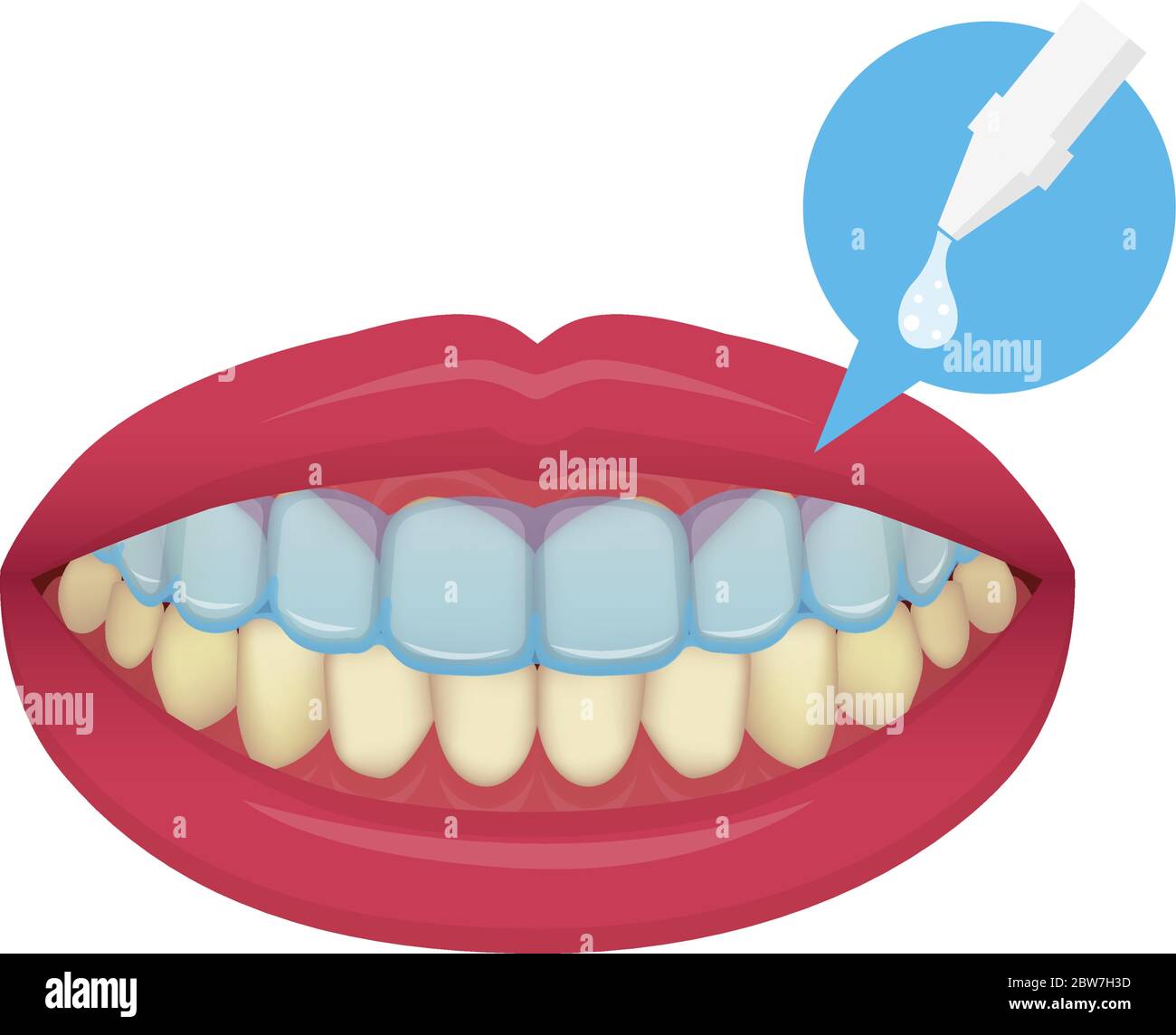 Teeth whitening at home vector illustration / no text Stock Vector ...